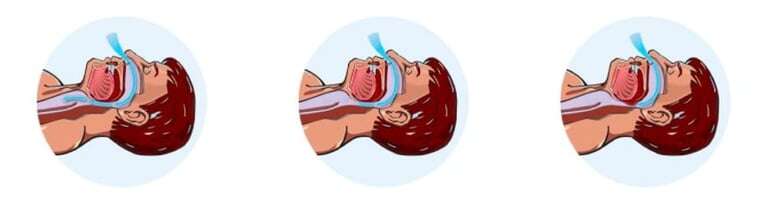 Are You New To Sleep Apnea Treatment?